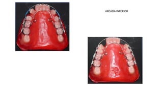 ANCLAJE,CONCEPTO,TIPOS Y MANEJO CLINICO.pptx