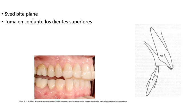 Anclaje en ortodoncia | PPTX