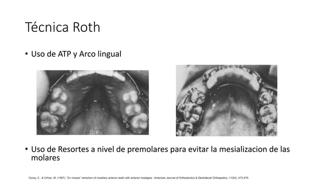 Anclaje en ortodoncia | PPTX