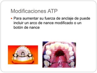 Anclaje en ortodoncia | PPTX