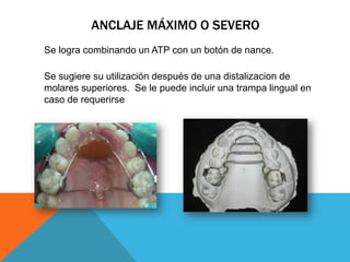 Anclaje y tracción | PPTX
