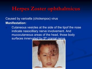 HIV/AIDS AND THE EYE DISORDERS IN ALL AGE GROUP | PPT