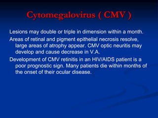 HIV/AIDS AND THE EYE DISORDERS IN ALL AGE GROUP | PPT