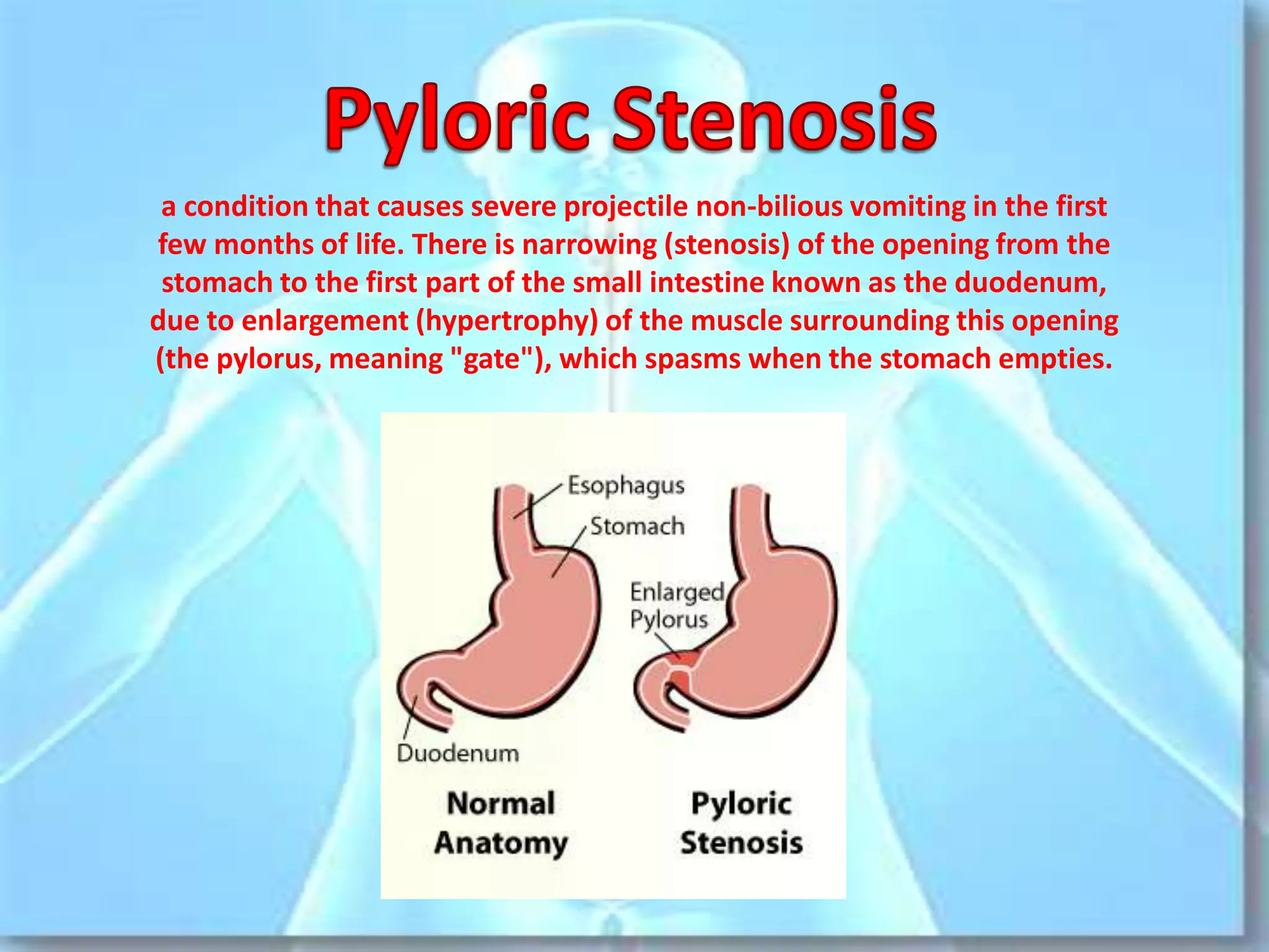 Gastrointestinal Tract Diseases | PPTX
