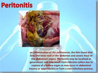 Gastrointestinal Tract Diseases | PPTX