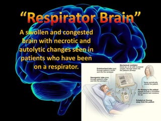 Respirator Brain