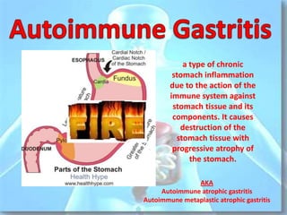 gi diseases | PPTX | Digestive Disorders | Diseases and Conditions