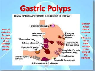 gi diseases | PPTX | Digestive Disorders | Diseases and Conditions