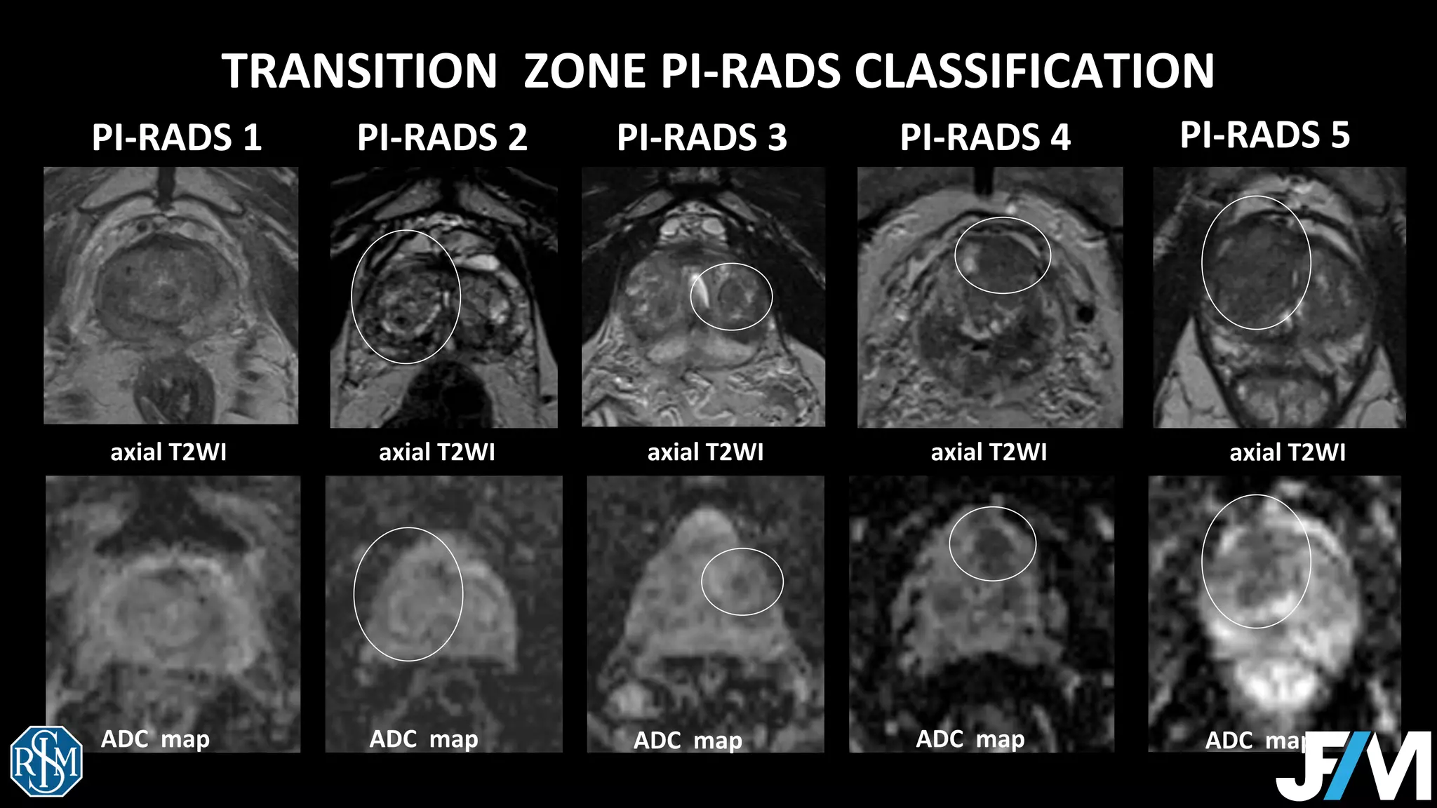 Andrea Esposito, prostate lesion use of multiparametric mr imaging for ...