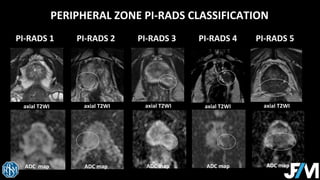 Andrea Esposito, prostate lesion use of multiparametric mr imaging for ...