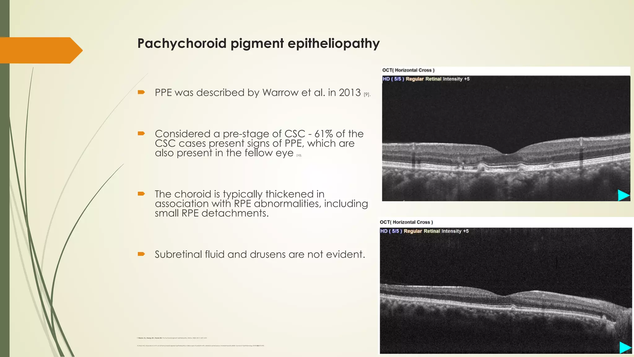 Andreea moraru pachychoroid spectrum of diseases | PDF