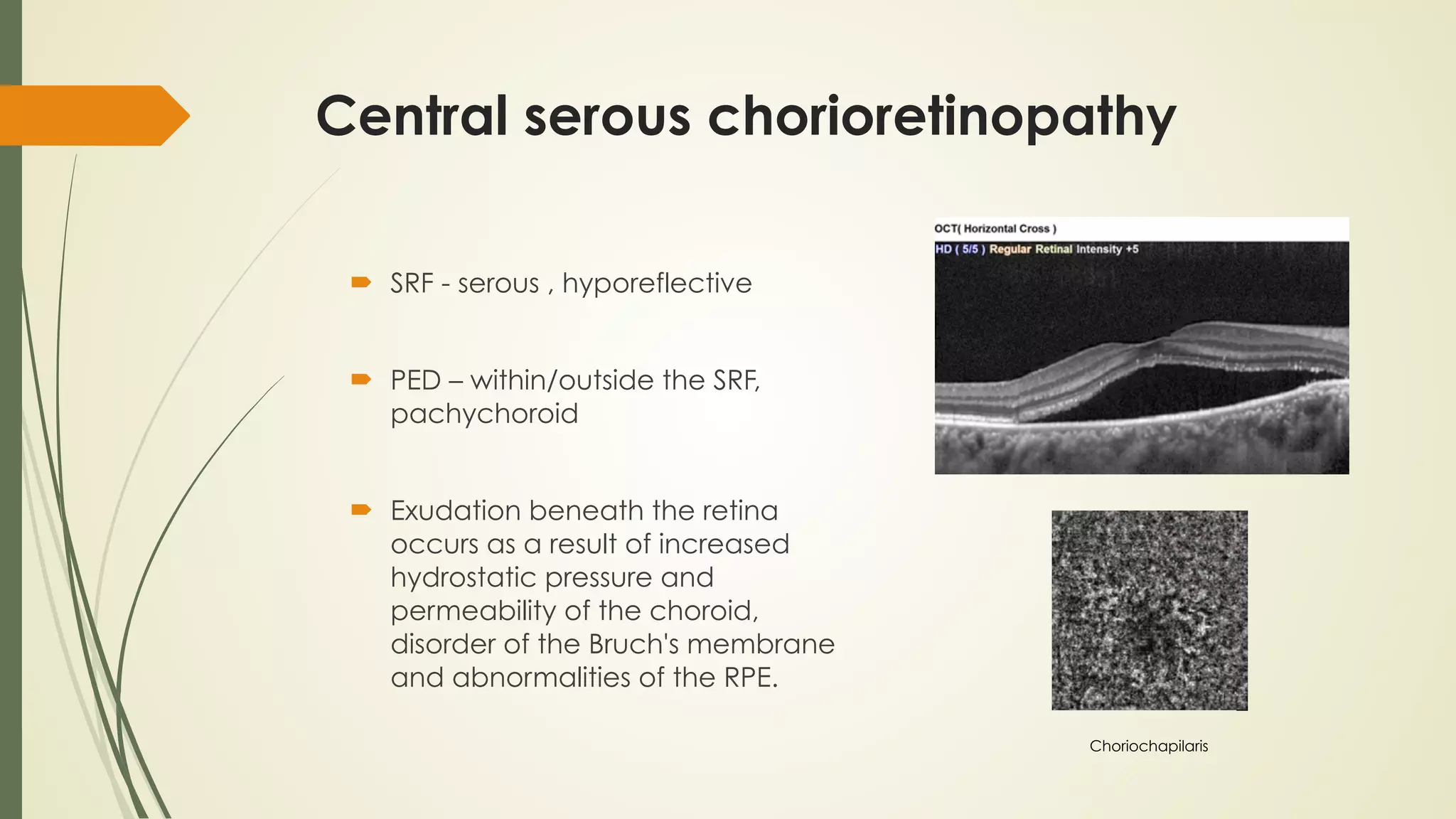 Andreea moraru pachychoroid spectrum of diseases | PDF