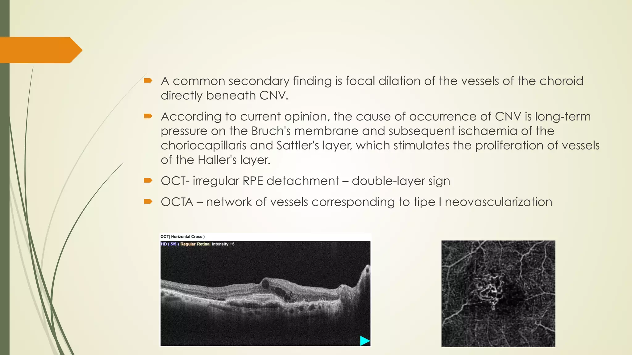 Andreea moraru pachychoroid spectrum of diseases | PDF