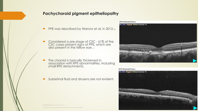 Andreea moraru pachychoroid spectrum of diseases | PDF