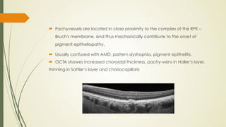 Andreea moraru pachychoroid spectrum of diseases | PDF