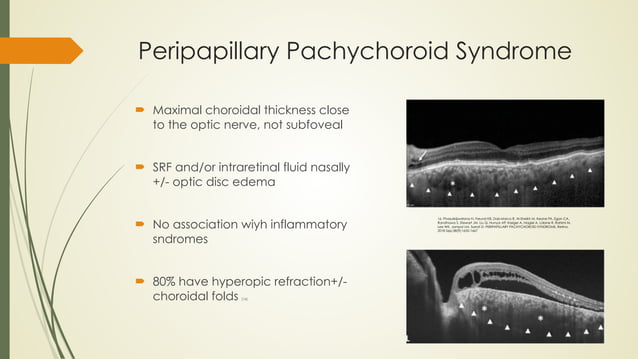Andreea moraru pachychoroid spectrum of diseases | PDF