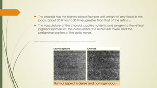 Andreea moraru pachychoroid spectrum of diseases | PDF