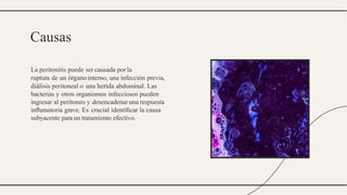 Peritonitis como detectarla y como realizar su tratamiento | PPTX