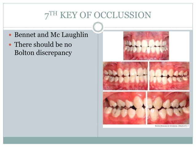 Andrew 6 keys of occlusion-1.pptx orthodontics | PPTX
