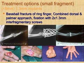 Hand intra articular fractures | PPT
