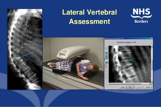 Vertebral Fracture Identification, Dr Andrew Pearson, #flschampions