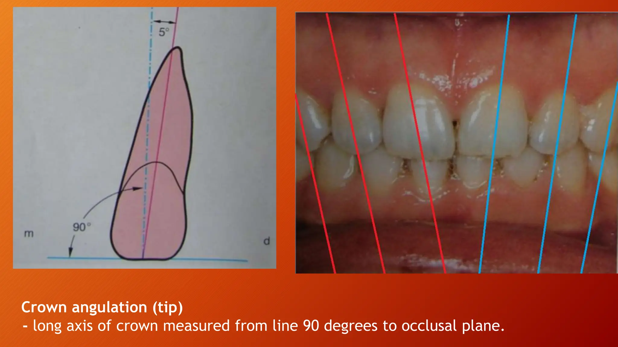 Andrews's six keys of ideal occlusion.pptx