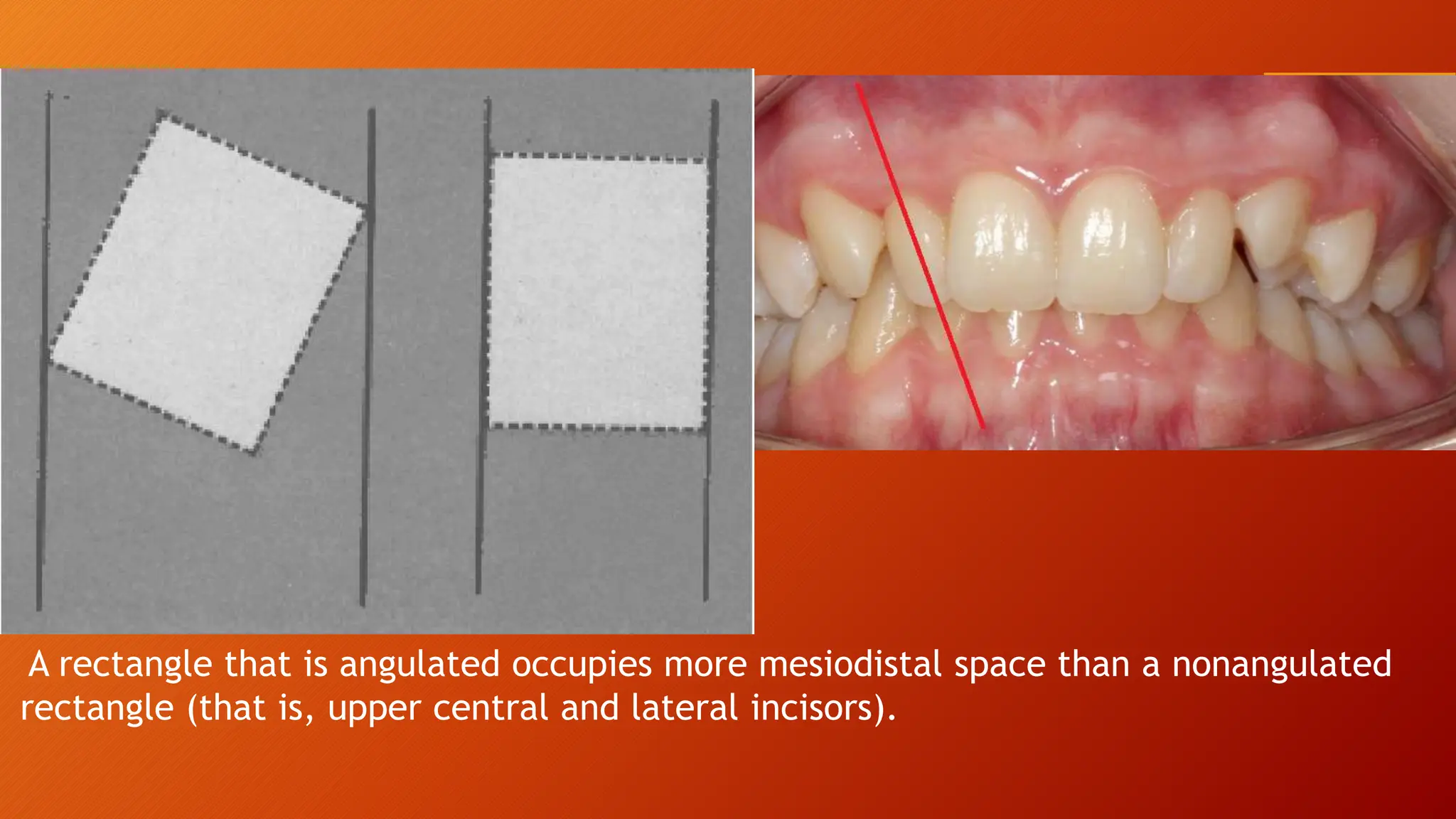 Andrews's six keys of ideal occlusion.pptx