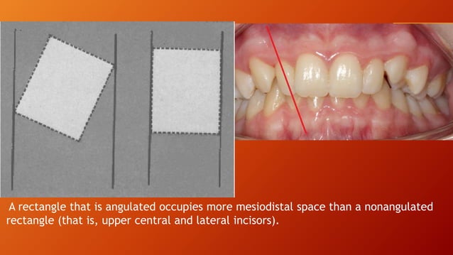 Andrews's six keys of ideal occlusion.pptx