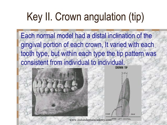 Andrews 6 Keys Of Normal Occlusion Certified Fixed Orthodontic Courses