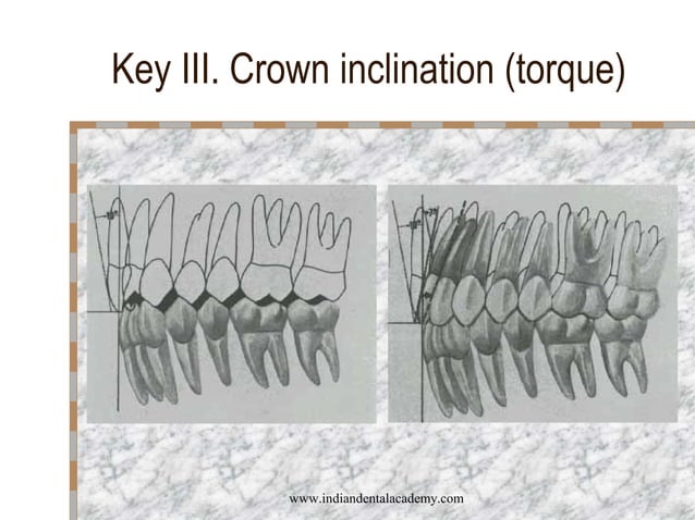 Andrews 6 Keys Of Normal Occlusion Certified Fixed Orthodontic Courses