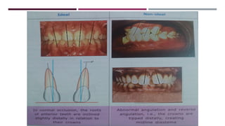 Andrews keys of occlusion in orthodontics | PPTX