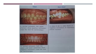 Andrews keys of occlusion in orthodontics | PPTX