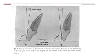 Andrews keys of occlusion in orthodontics | PPTX