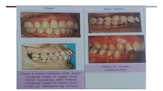 Andrews keys of occlusion in orthodontics | PPTX