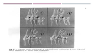 Andrews keys of occlusion in orthodontics | PPTX