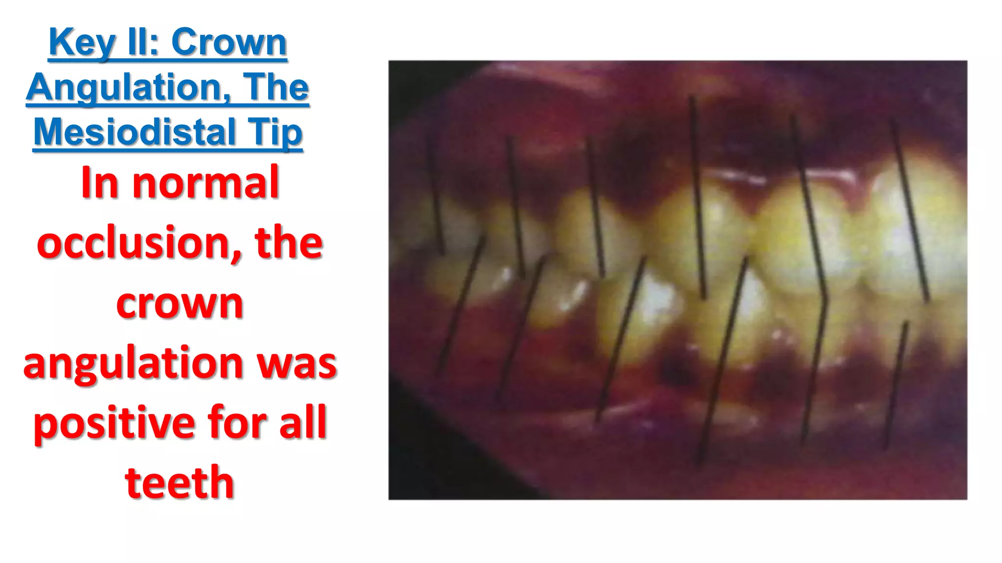 Andrew’s six keys of normal occlusion | PPTX