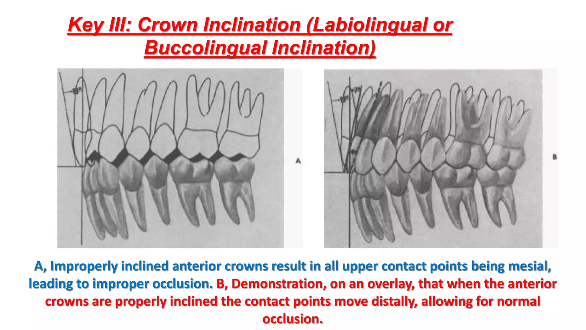 Andrew’s six keys of normal occlusion | PPTX