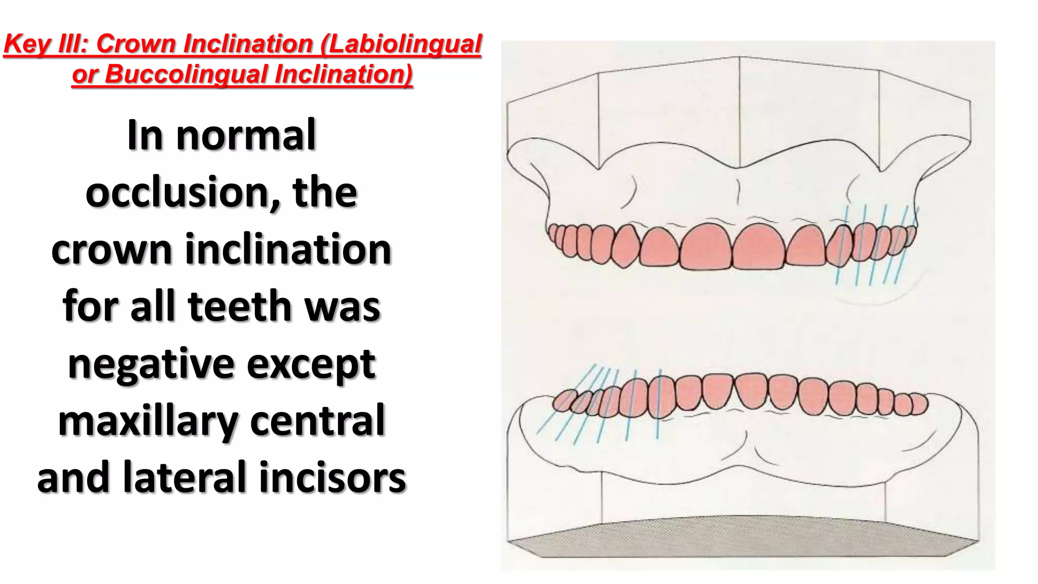 Andrew’s six keys of normal occlusion | PPTX