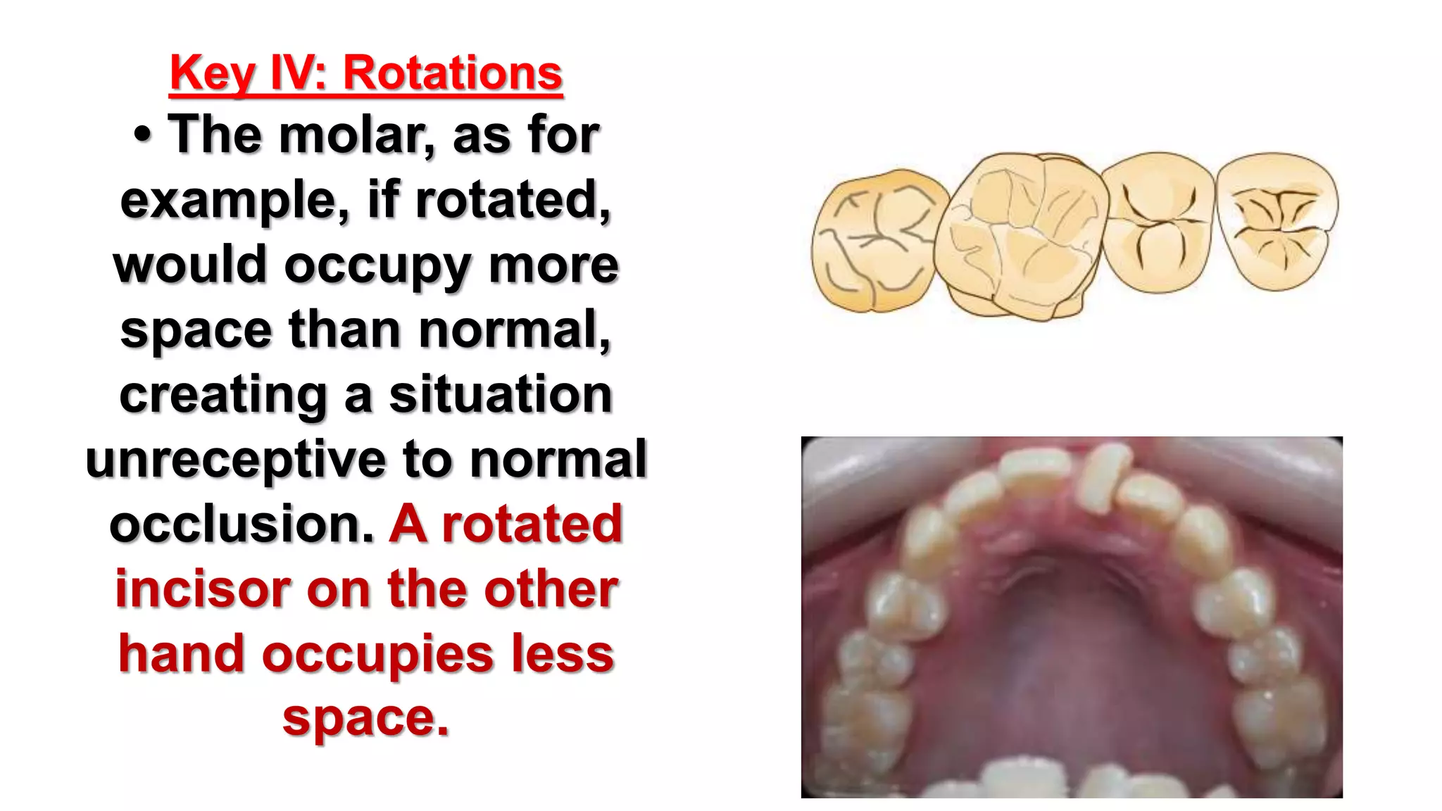 Andrew’s six keys of normal occlusion | PPTX