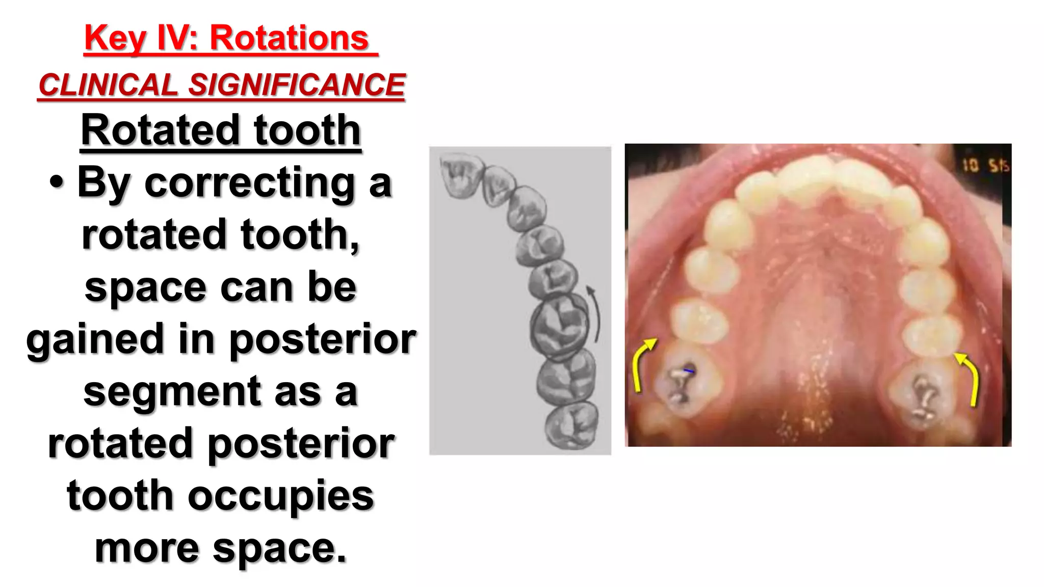 Andrew’s six keys of normal occlusion | PPTX