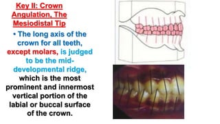 Andrew’s six keys of normal occlusion | PPTX