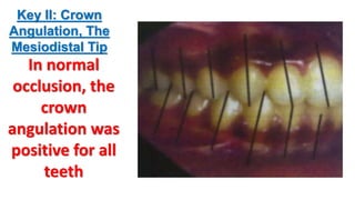 Andrew’s six keys of normal occlusion | PPTX