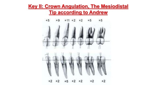 Andrew’s six keys of normal occlusion | PPTX | Dental Health | Diseases ...