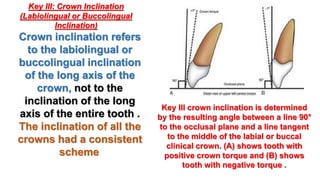 Andrew’s six keys of normal occlusion | PPTX