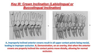 Andrew’s six keys of normal occlusion | PPTX