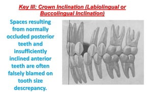Andrew’s six keys of normal occlusion | PPTX