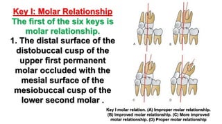 Andrew’s six keys of normal occlusion | PPTX