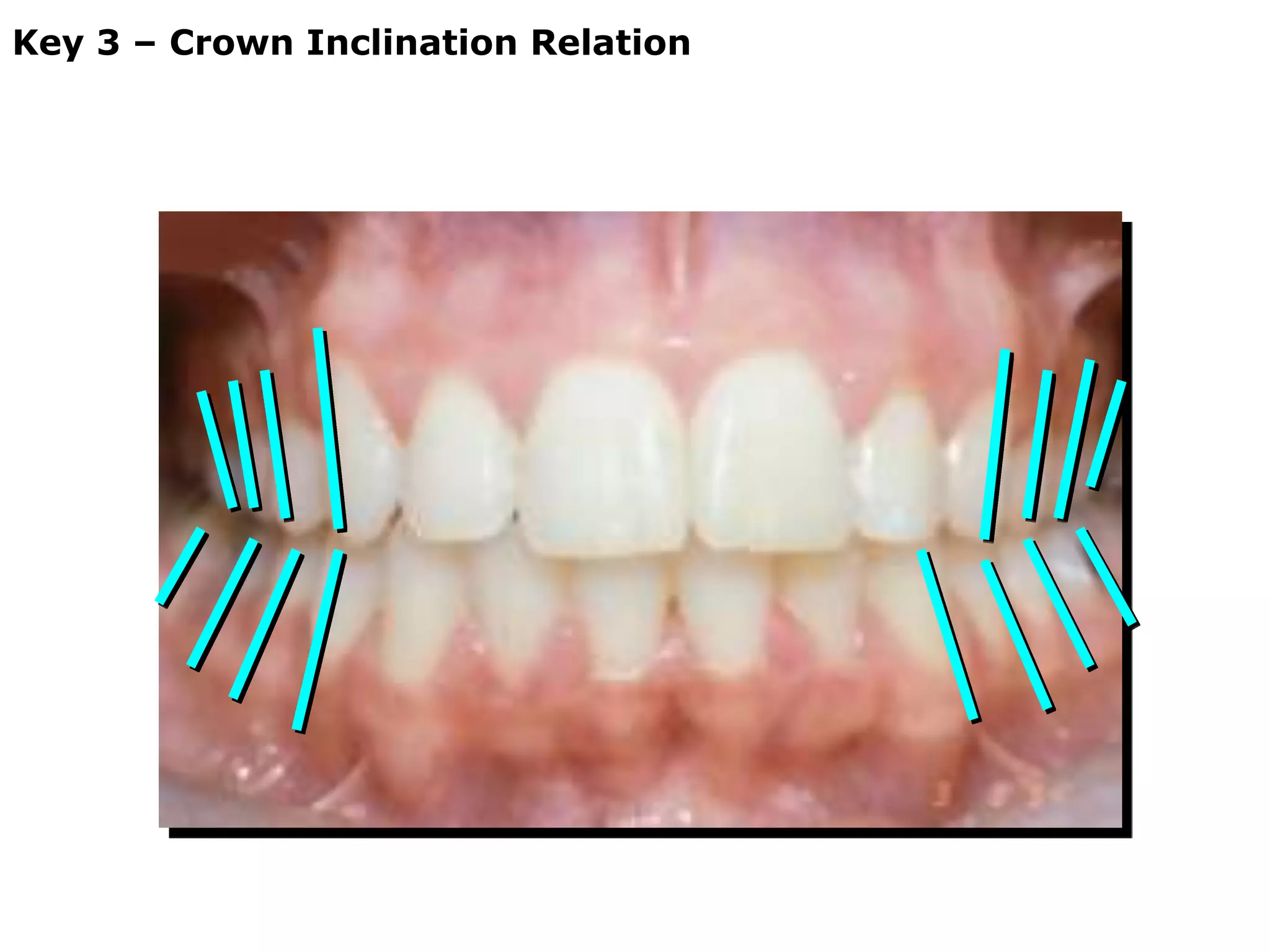 Andrews' six keys to normal occlusion | PDF