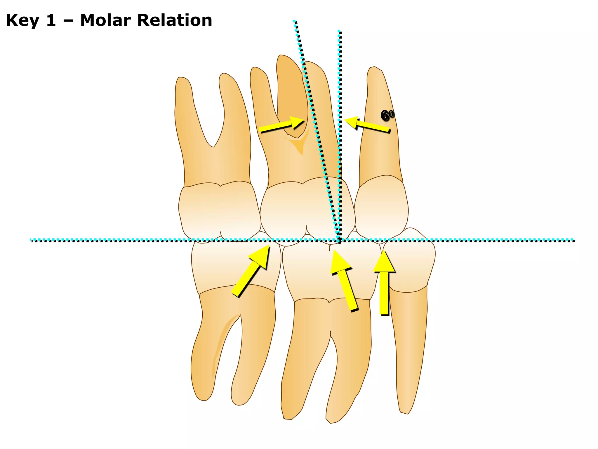 Andrews' six keys to normal occlusion | PDF