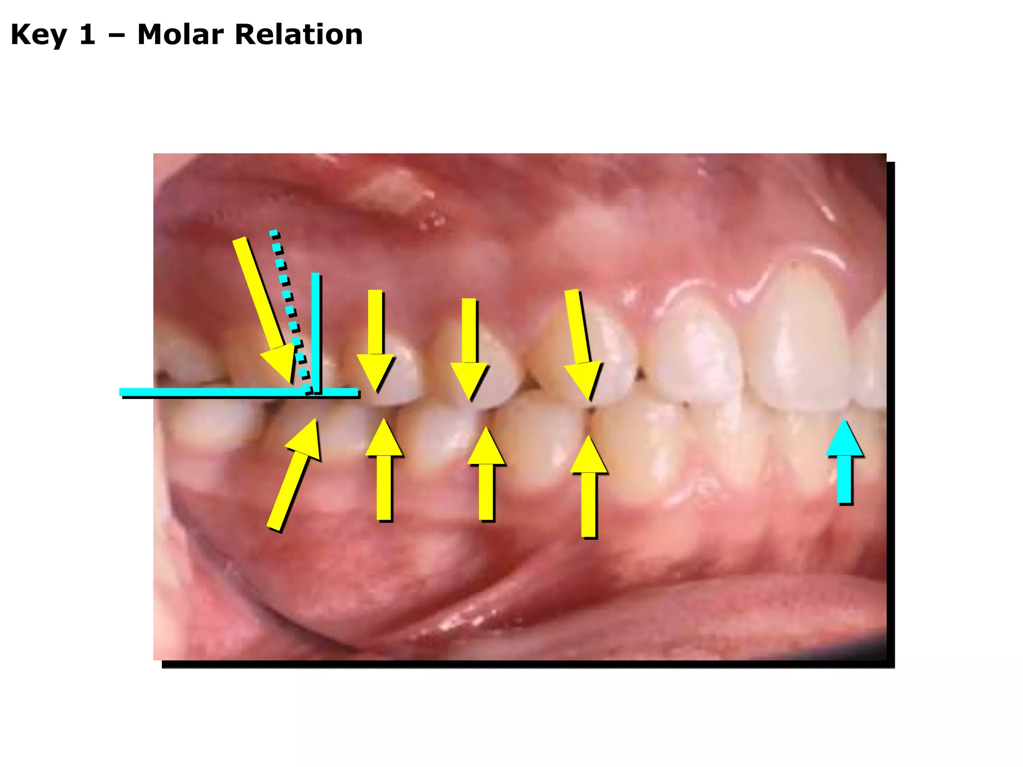 Andrews' six keys to normal occlusion | PPT